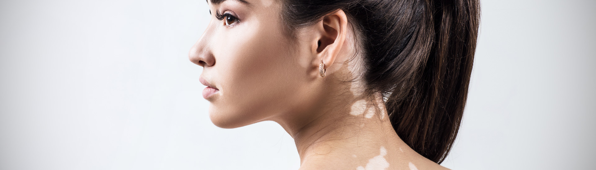 Best Vitiligo Surgeries in Guntur | Expert Dermatologist - Leelavathi ...